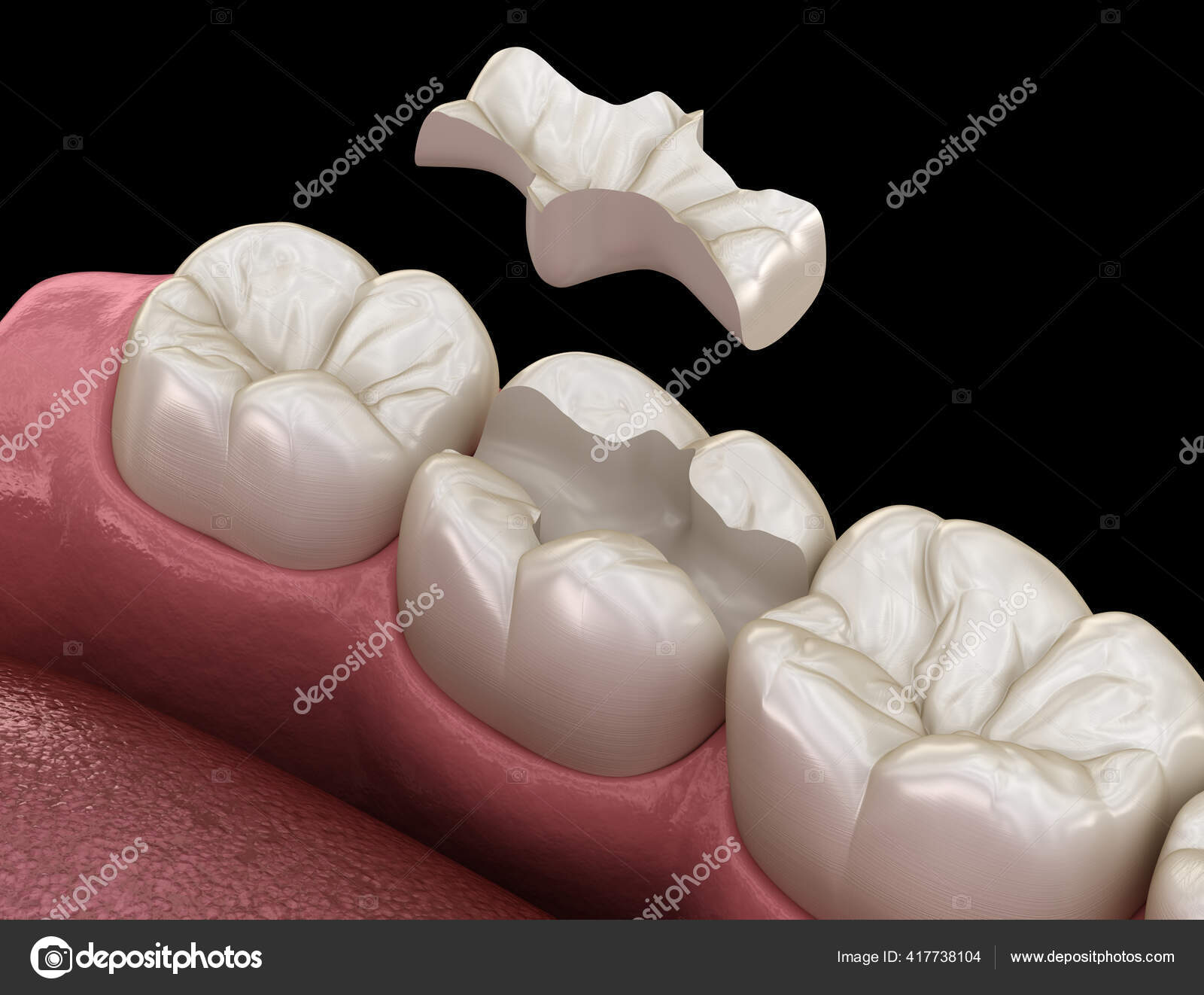 Inlay Ceramic Crown Fixation Tooth Medically Accurate Illustration ...