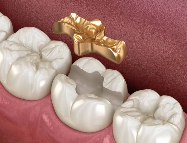 Golden Crown Molar Tooth Assembly Process Medically Accurate ...