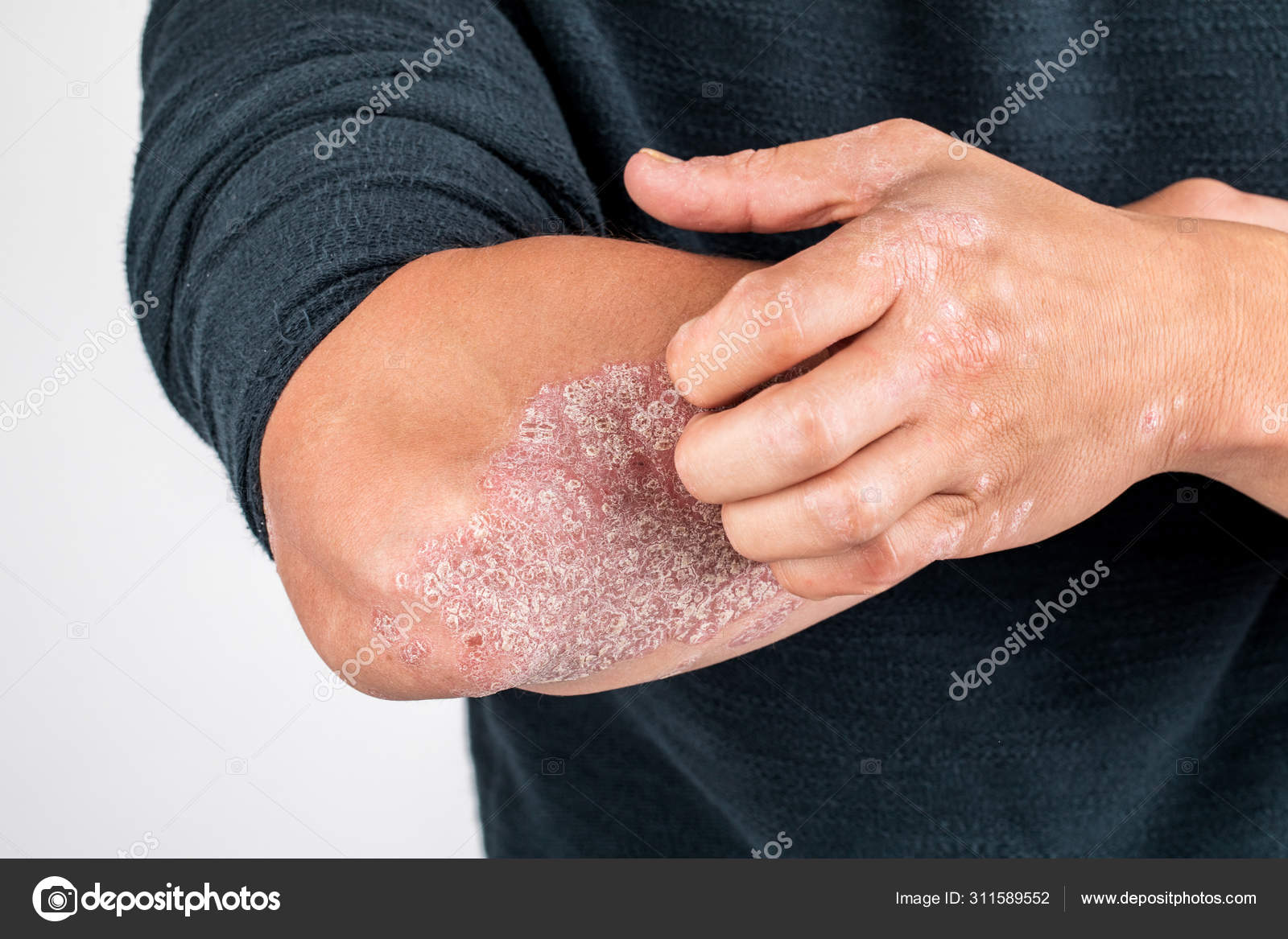 Hombre con manos enfermas, piel seca y escamosa en su mano con psor ...