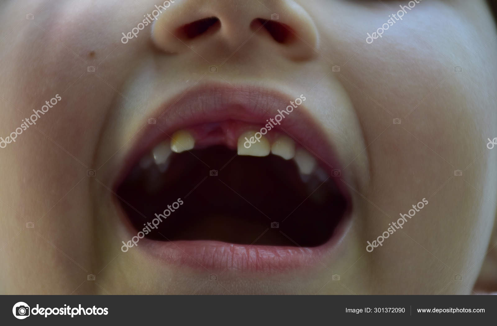 Tooth Fell Out Child Stock Photo by ©GalinkaLB 301372090