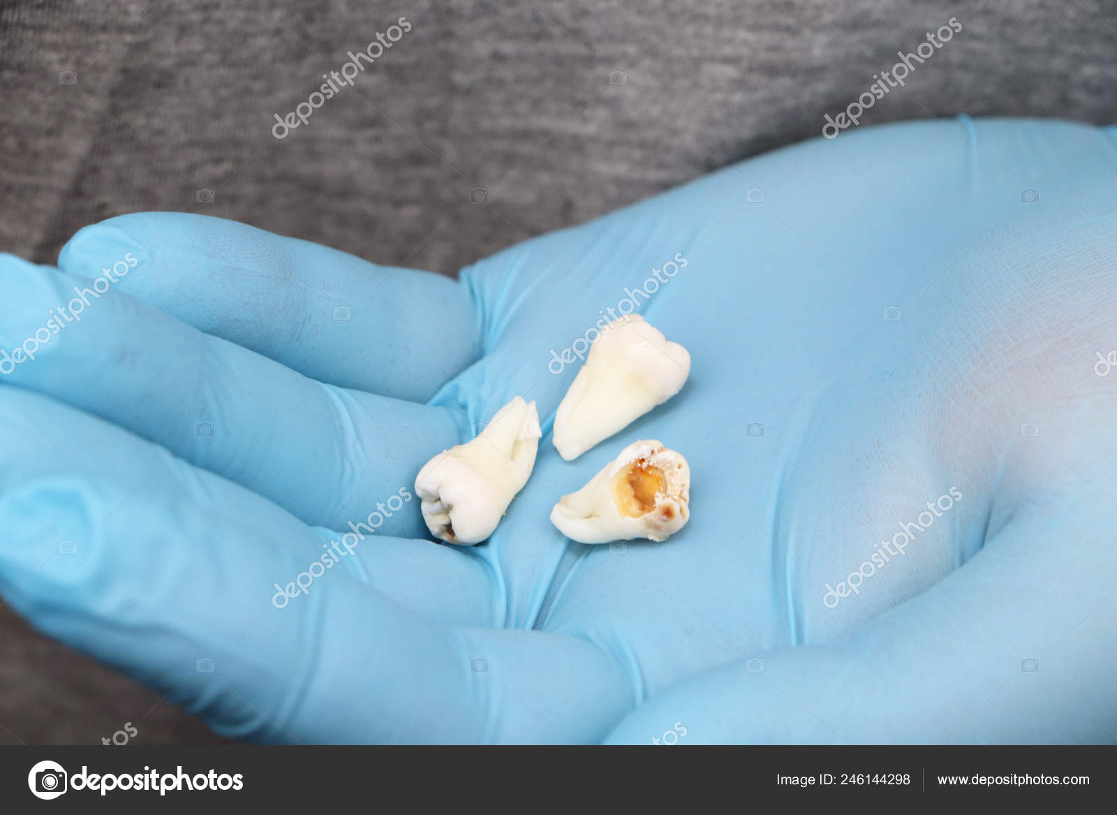 Man Removing Wisdom Tooth Operation Remove Eighth Teeth — Stock Photo ...
