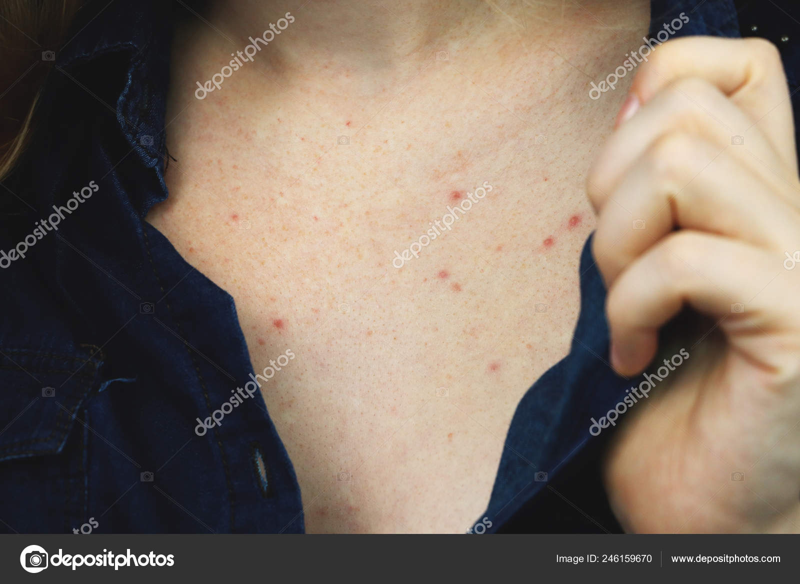Allergy Concept Young Woman Pimples Chest Closeup — Stock Photo ...