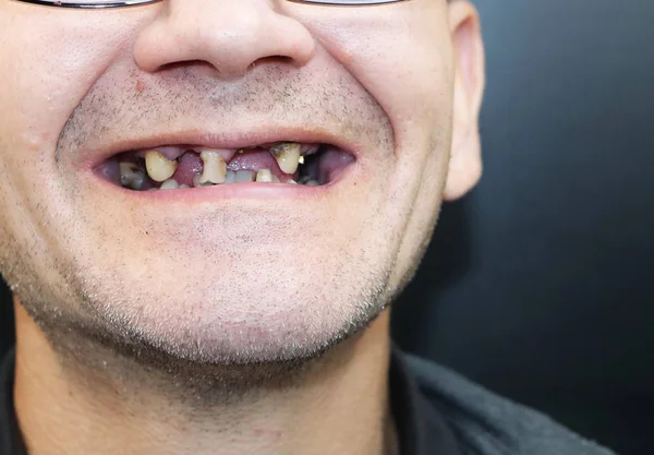 Fotos de Dientes podridos, Imágenes de Dientes podridos ⬇ Descargar ...