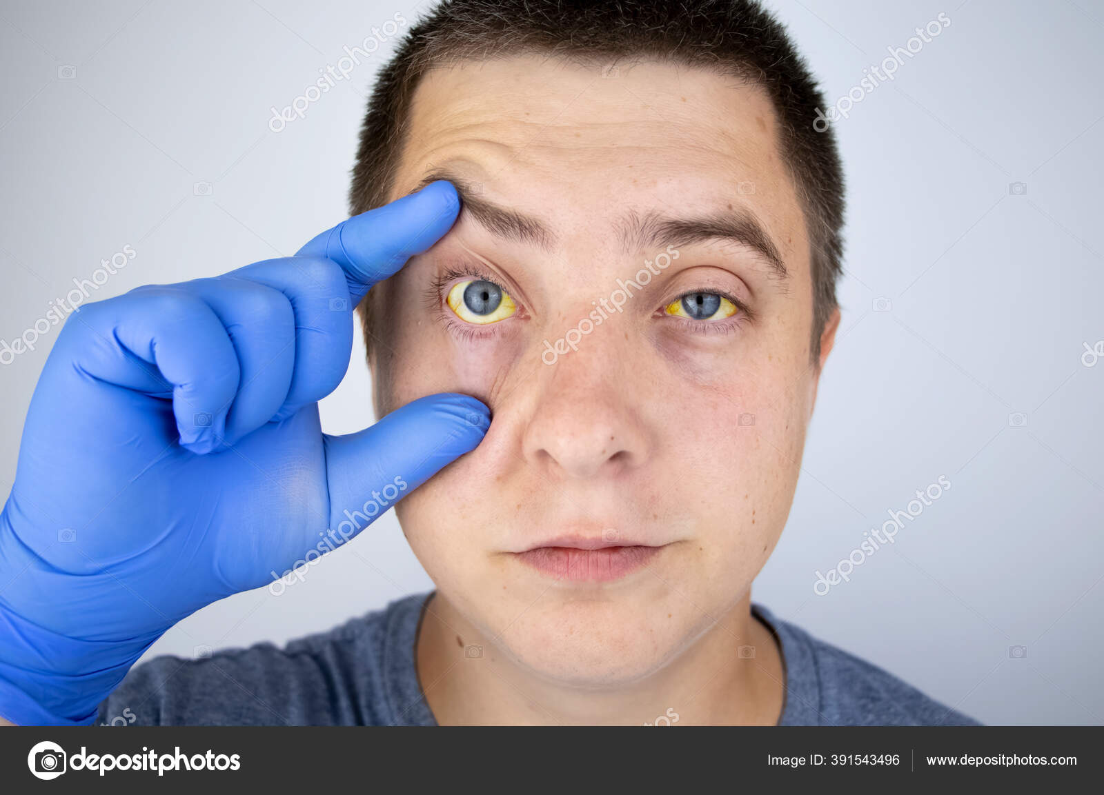 Gele Ogen Hepatitis Gele Kleur Van Het Mannelijke Oog Symptoom Van