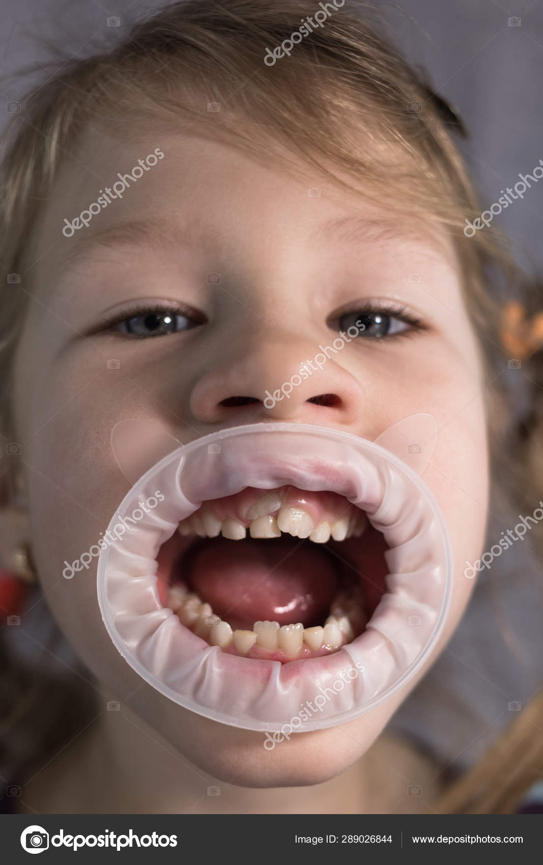 Adult permanent teeth coming in front of the child's baby teeth: ⬇ ...
