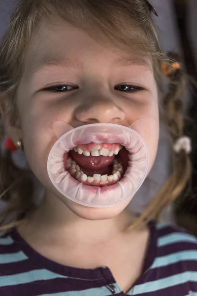 Adult permanent teeth coming in front of the child's baby teeth: ⬇ ...