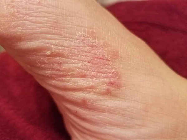 Poison ivy rash Stock Photos, Royalty Free Poison ivy rash Images ...