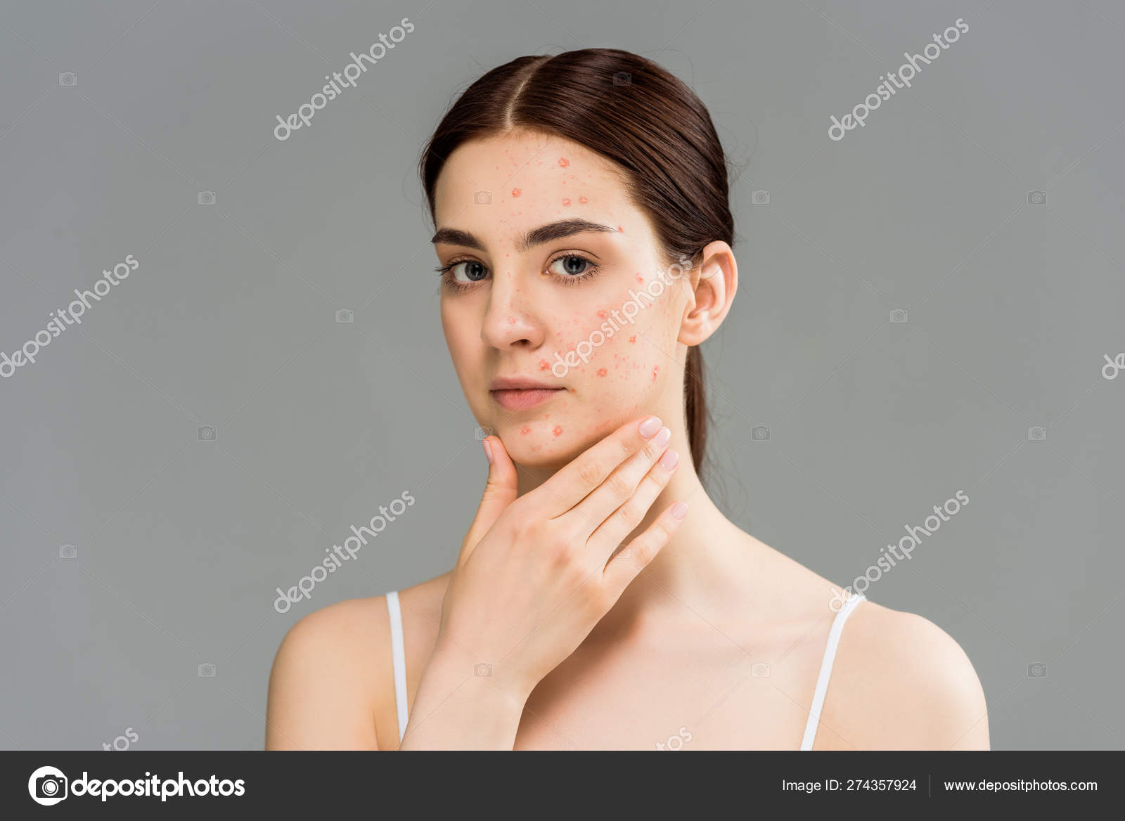 Beautiful Young Woman Pimples Touching Face Isolated Grey — Stock Photo ...