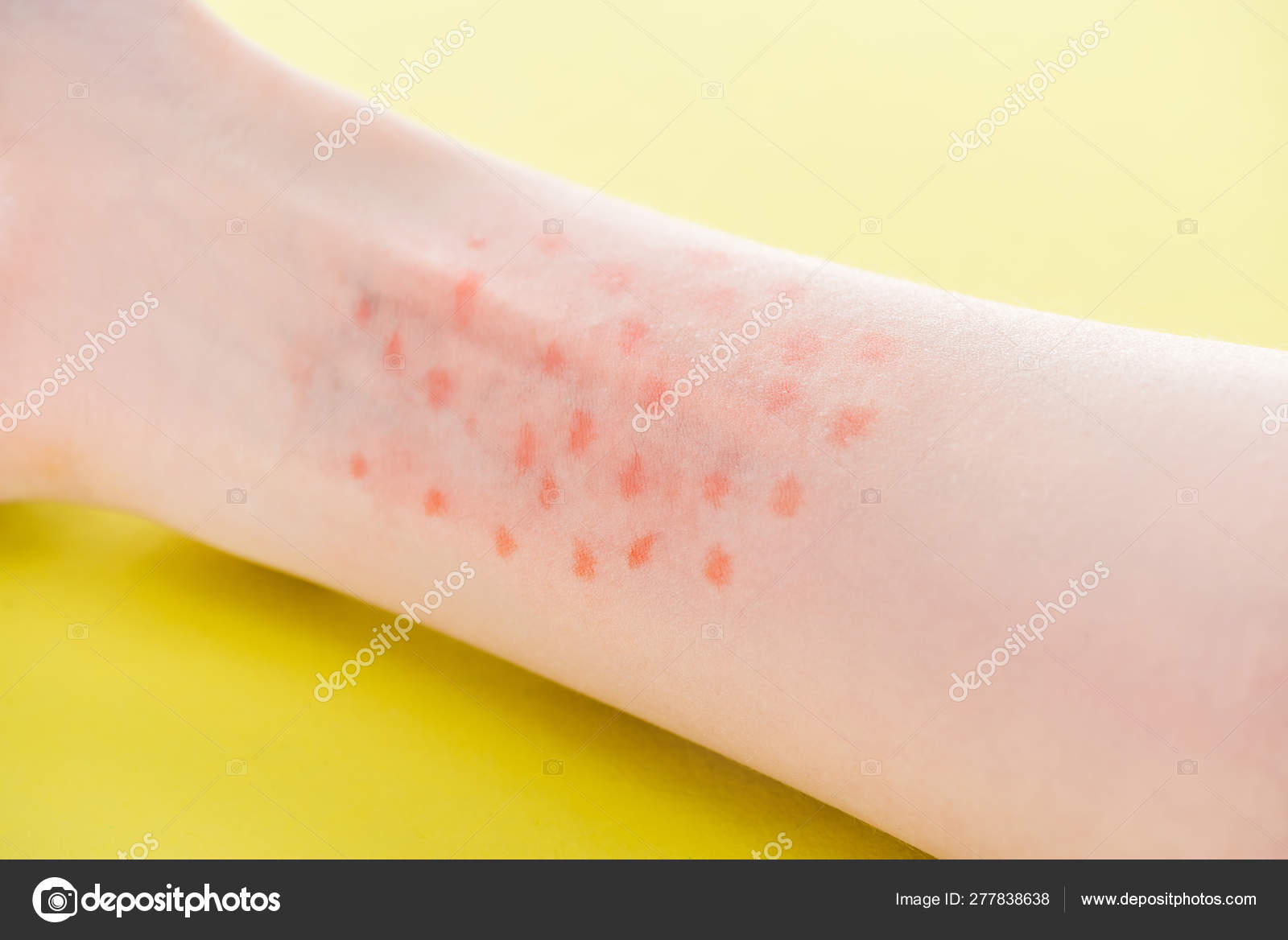 Cropped View Allergy Rush Hand Yellow Background Stock Photo by ...