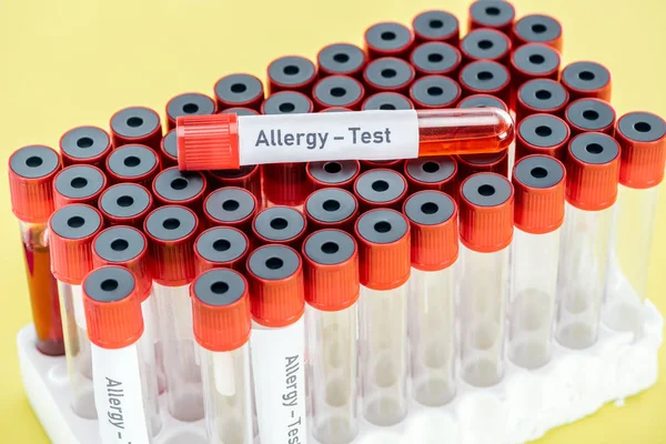 Cropped View Doctor Holding Sample Allergy Test Lettering Test Tubes ...