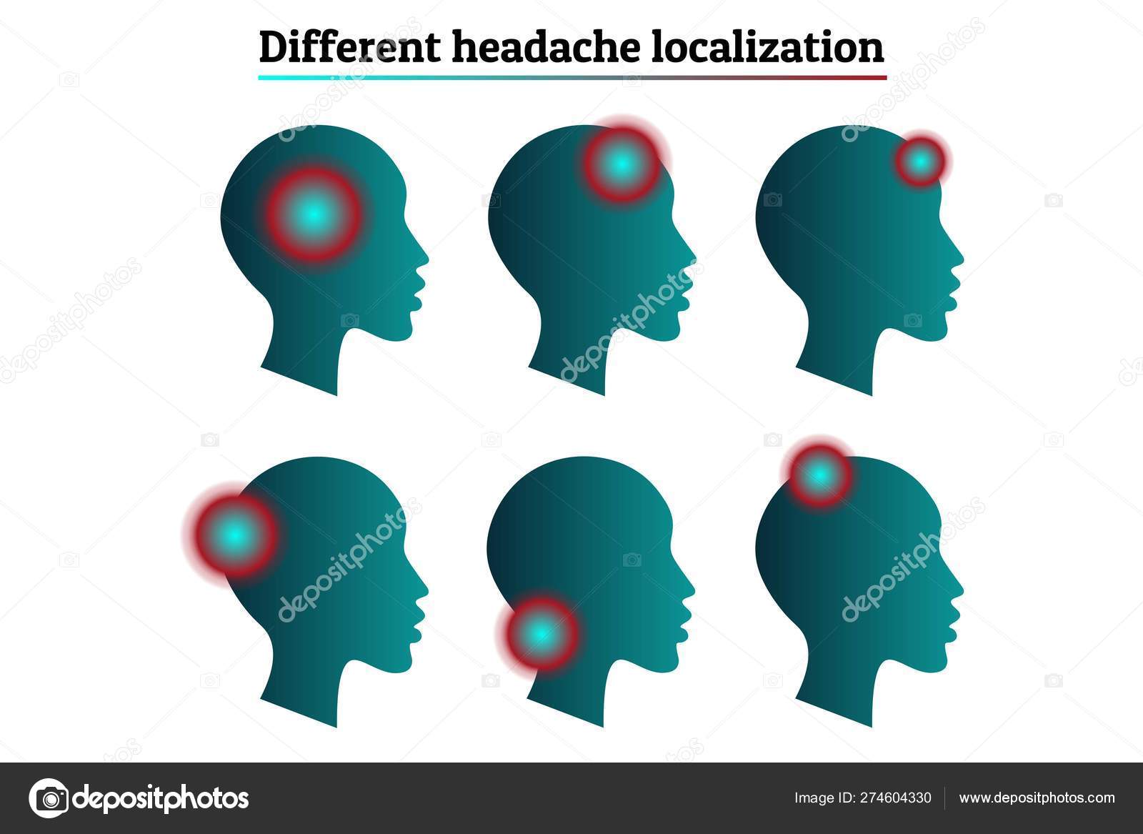 Medical infographic template set - types and localizations of headache ...