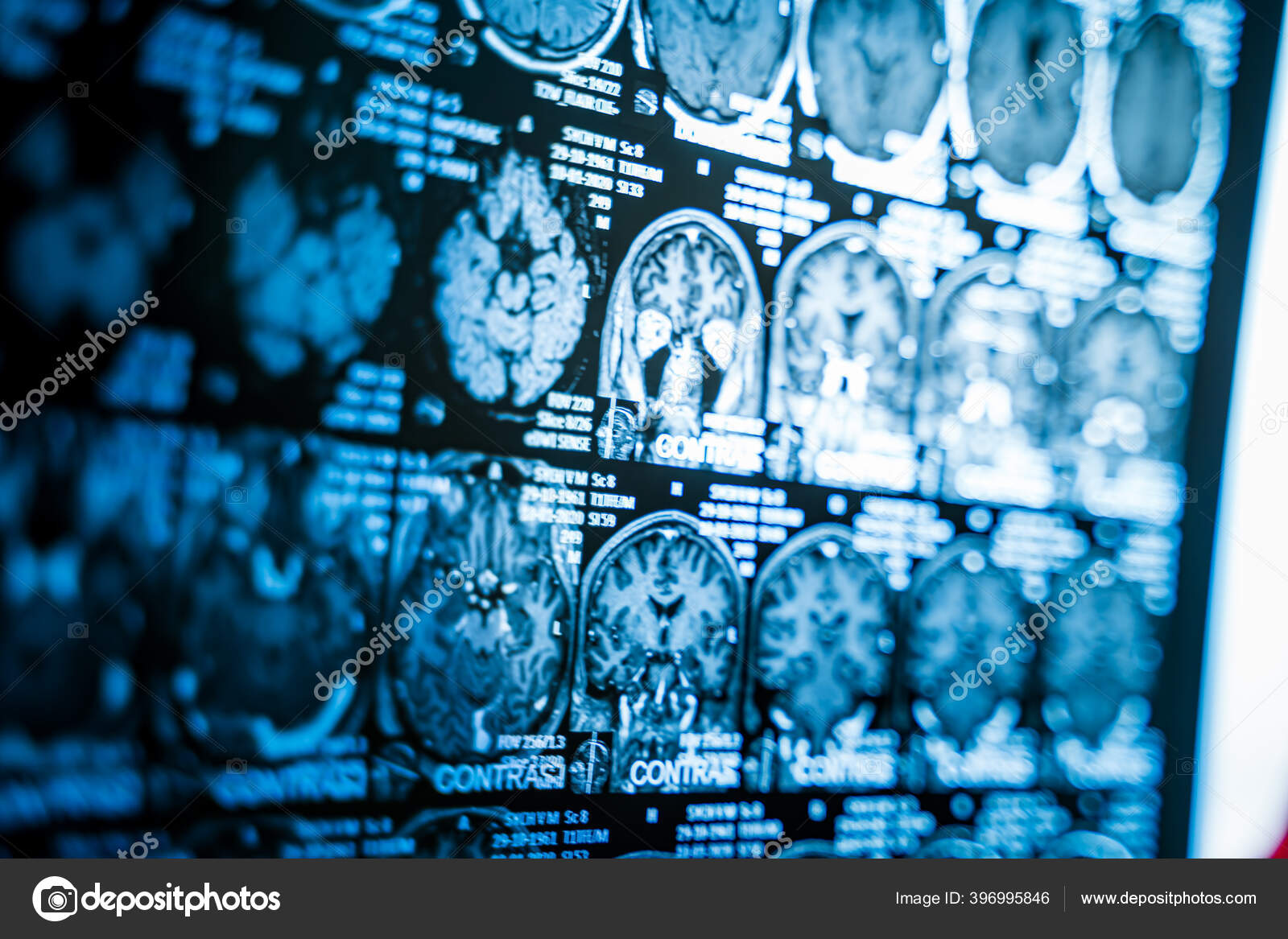 Close Scan Brain Skull Neurosurgery Concept Stock Photo by ©wedmov ...