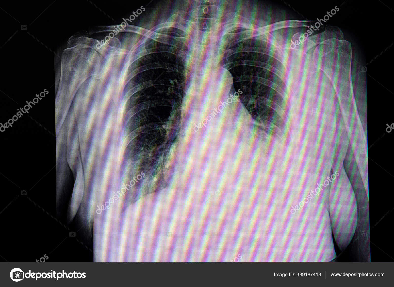 Radiografía De Tórax Derrame Pleural