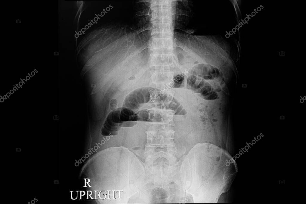 Radiografía abdominal de un paciente con obstrucción intestinal ...