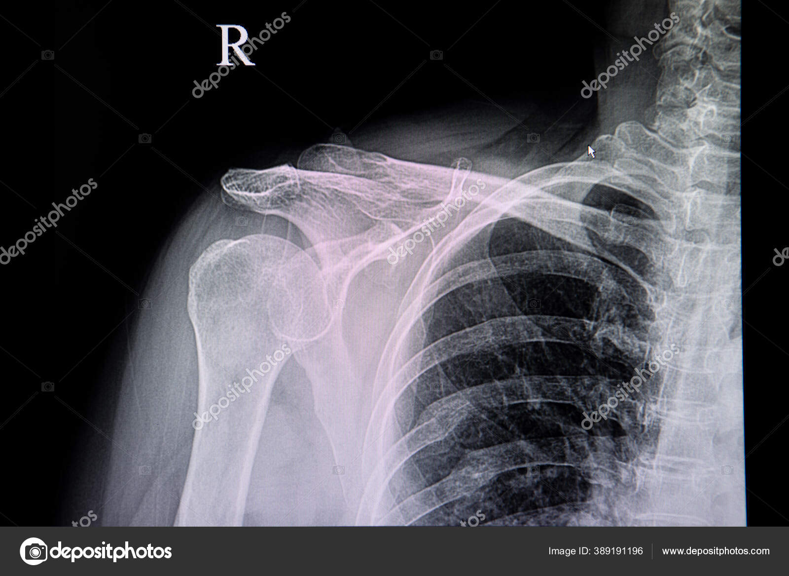 Chest Xray Patient Old Ribs Fracture Stock Photo by ©navuths@gmail.com ...