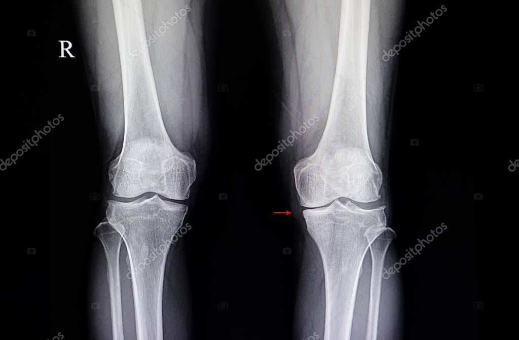 Imagen de rayos X de la rodilla izquierda de un paciente con ...