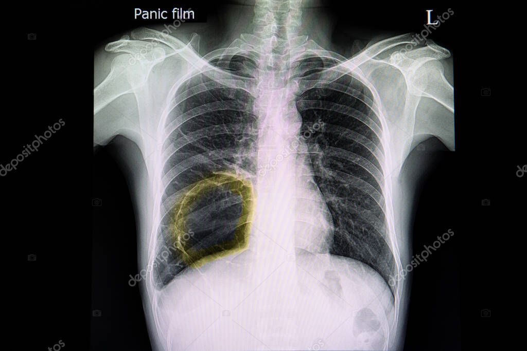 Una radiografía de tórax de un paciente con una gran masa pulmonar en ...
