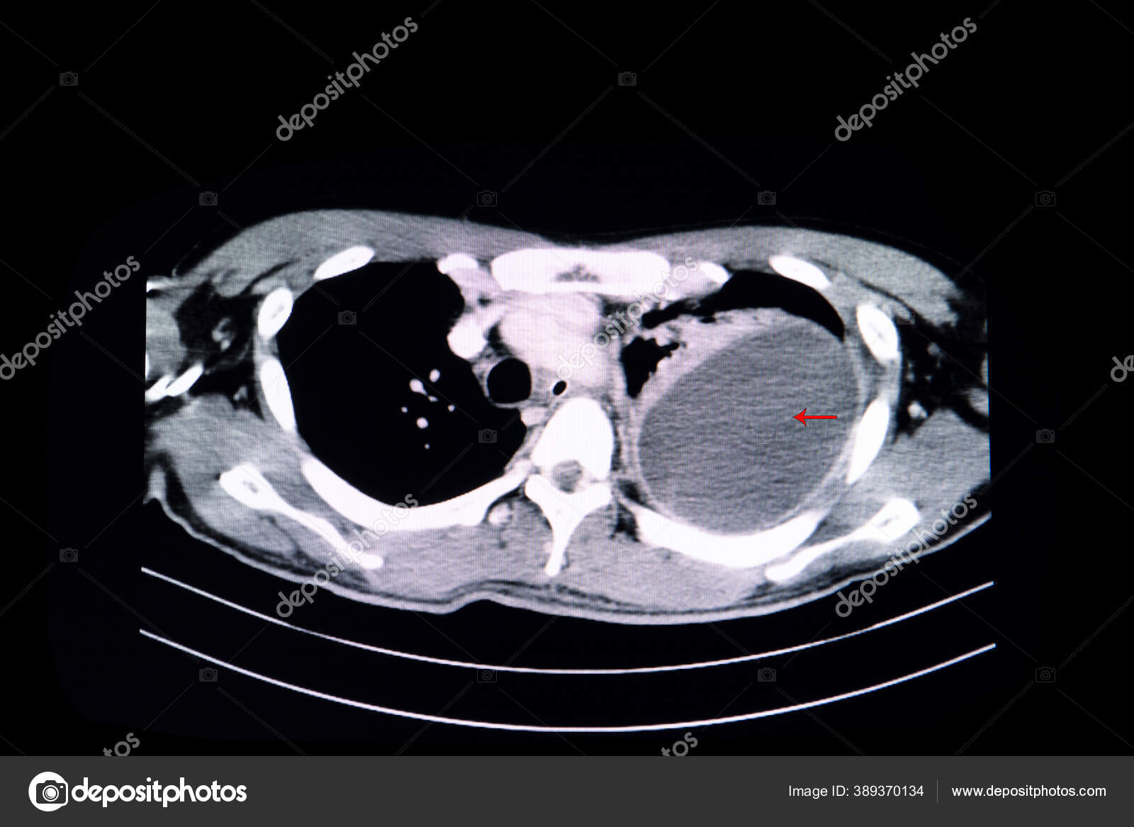 Anatomía De La Tomografía Computarizada Del Tórax Toracostomía Con