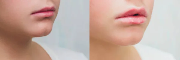 Puncture and skin Stock Photos, Royalty Free Puncture and skin Images ...