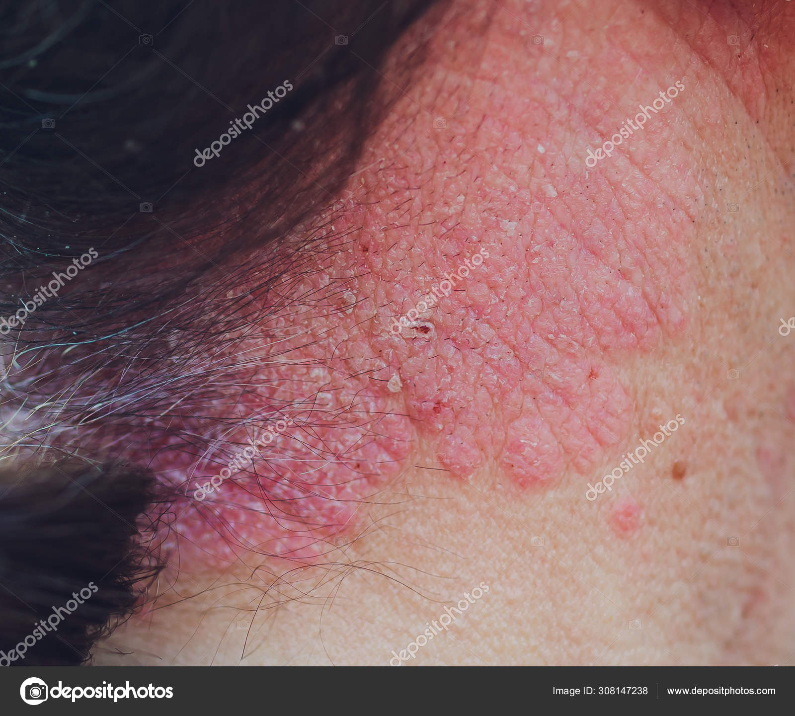 Fake Head And Shoulders Rash