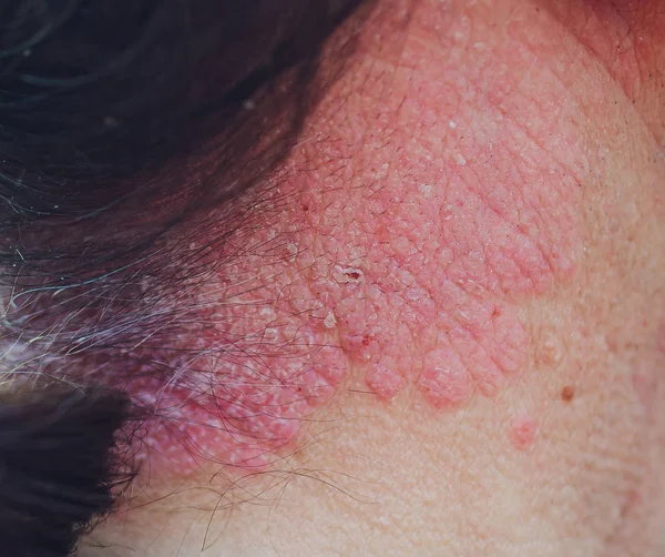 Scalp scab Stock Photos, Royalty Free Scalp scab Images | Depositphotos