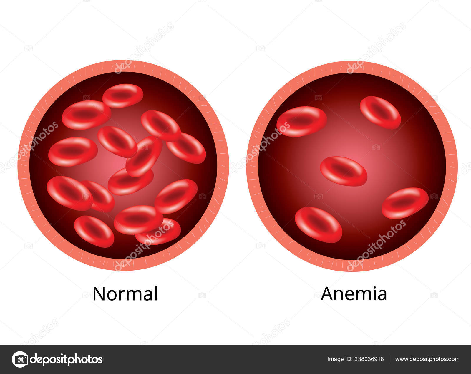 Infographic Image Blood Healthy Human Blood Vessel Anemia ⬇ Vector ...