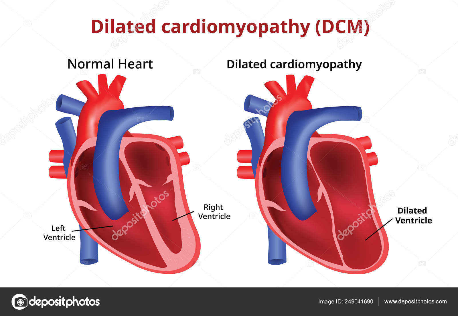 Dilated cardiomyopathy, Heart disease, Vector image — Stock Vector ...