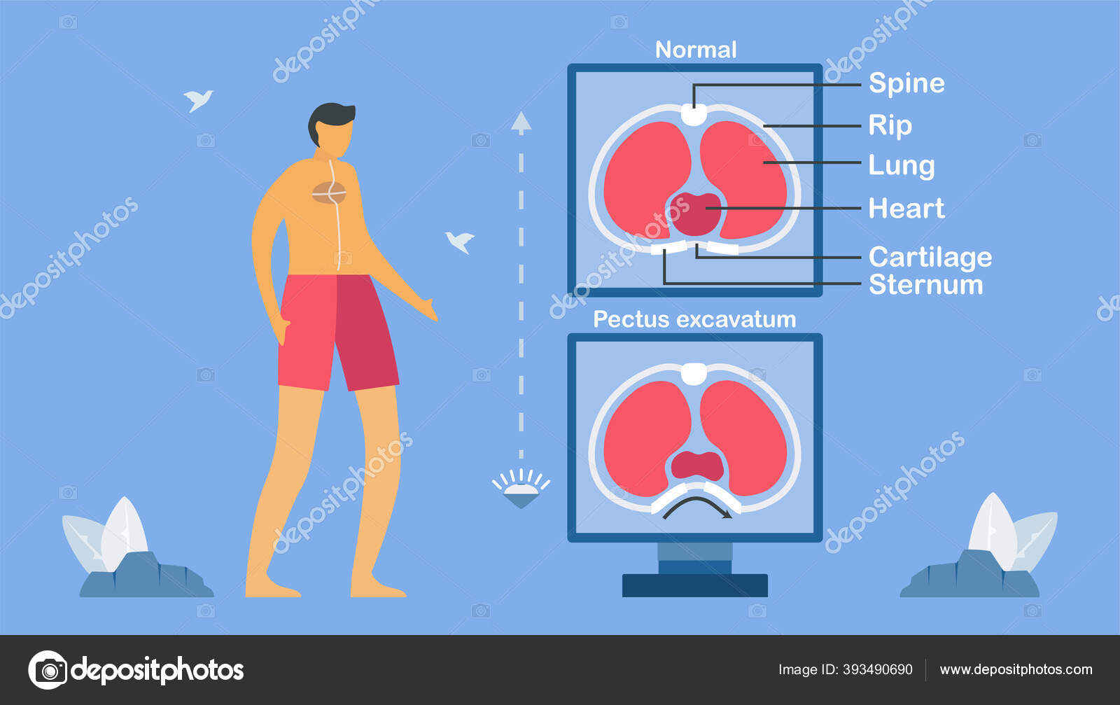 My Pectus Excavatum Funnel Chest Nuss Procedure Read