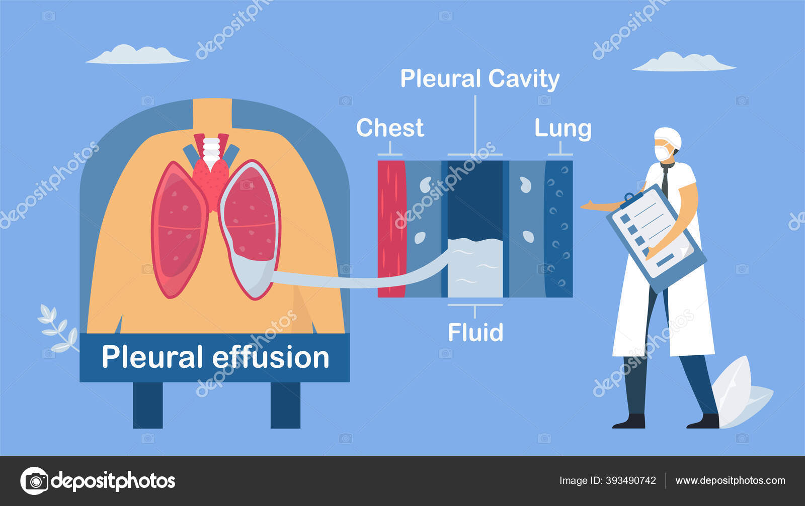 Pleural Effusion Collection Excess Fluid Layers Pleura Lungs ...