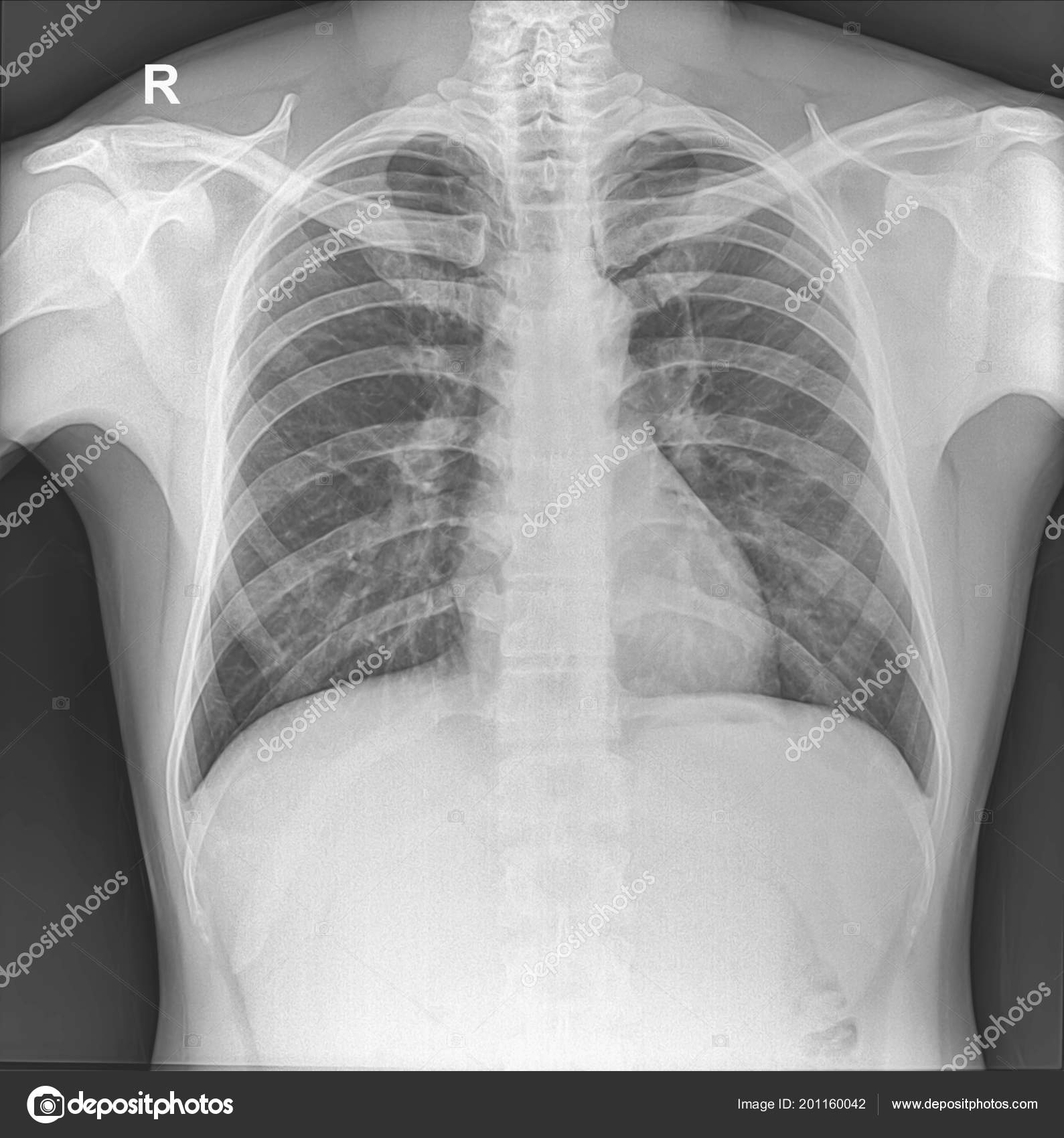 Radiografia De Torax Normal Rotulada