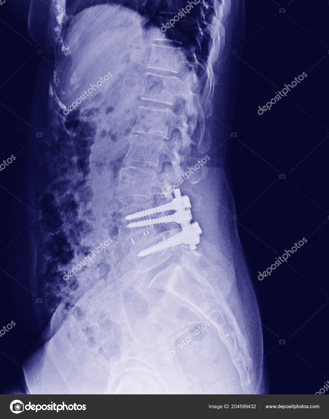 Ray Pelvis Spinal Column Side View Post Open Reduction Internal Stock ...
