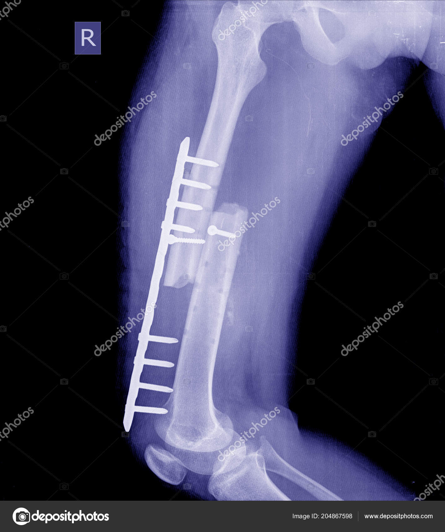 Bilder Von Gebrochenem Oberschenkelknochen Ein Mann Mit Ein Gebrochen