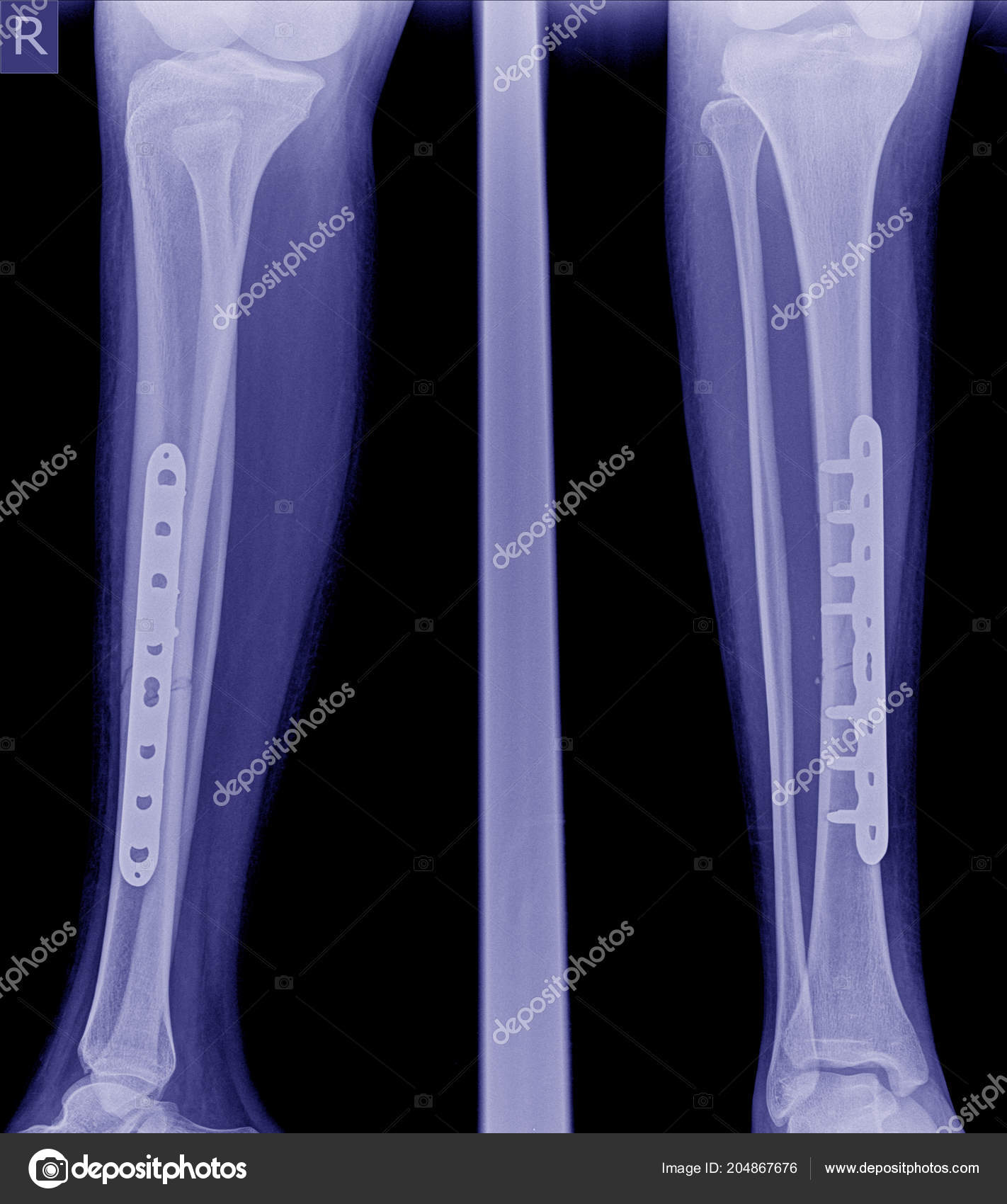 X Ray Broken Leg