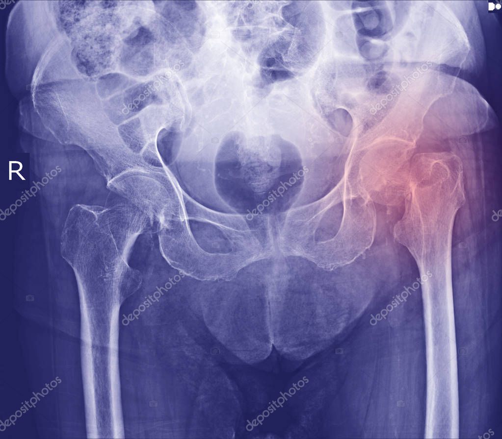 Imagen de rayos X de la cadera dolorosa en el hombre presentando ...