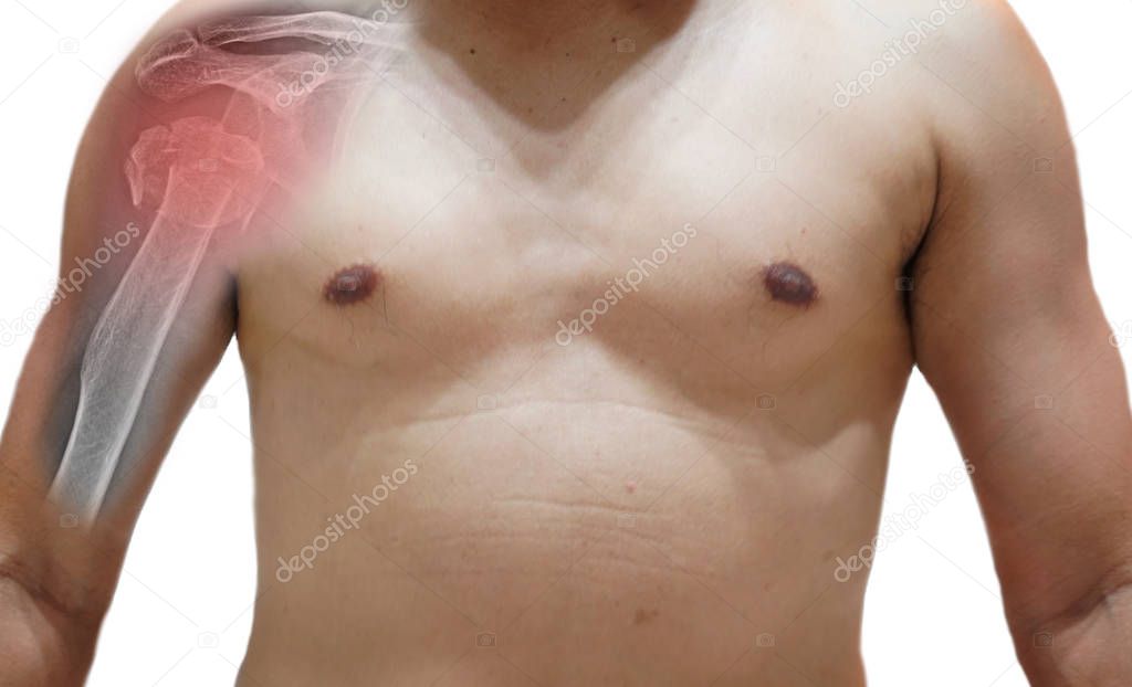 Primer plano El hombro humano con rayos X muestra fractura en el cuello ...