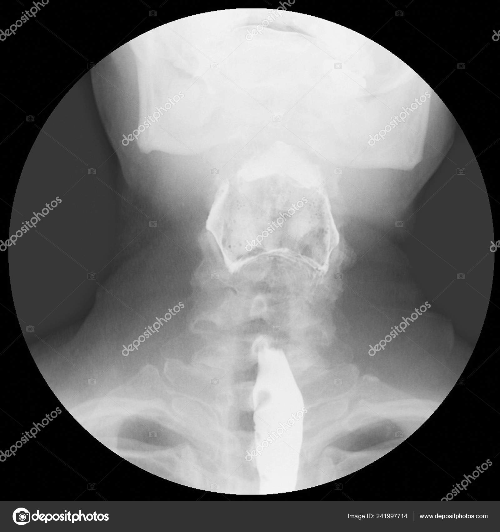 Special Ecamination Baruim Swallow Normal Swallowing Funcion Normal ...