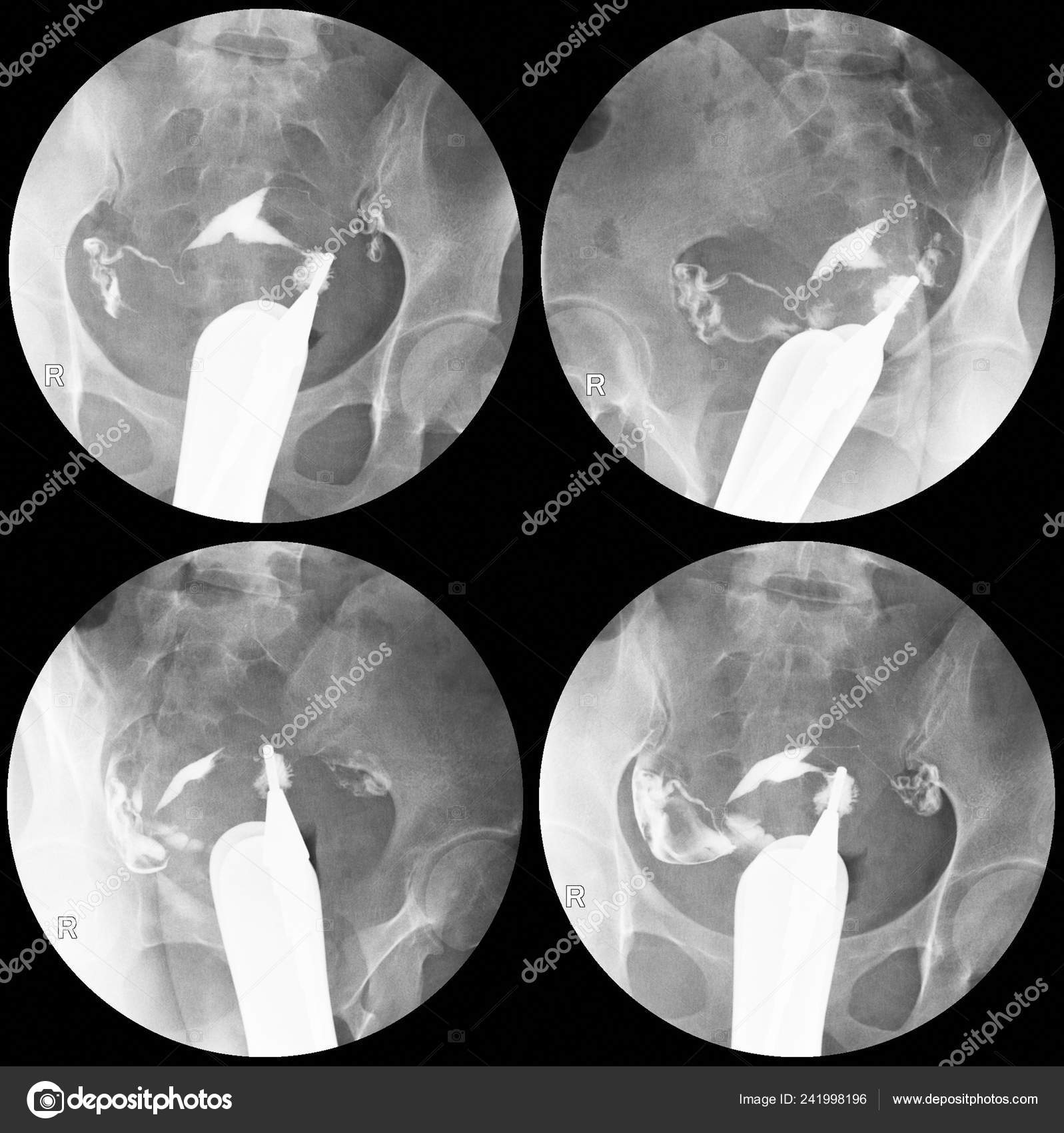 Hysterosalpingography Radiology Uterus Normal Size Shape Both Tubes ...