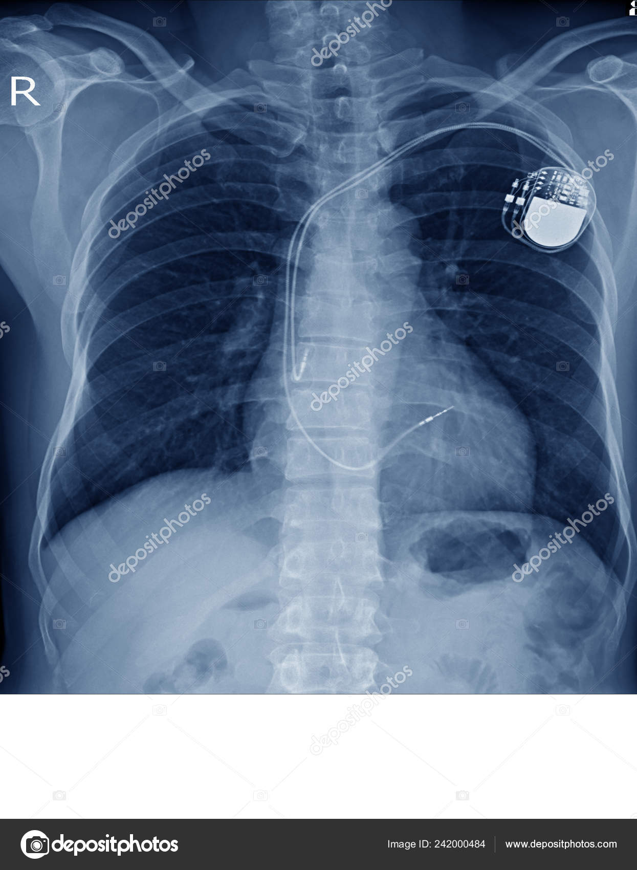 Ray Image Permanent Pacemaker Implant Chest Body Process Blue Tone ...