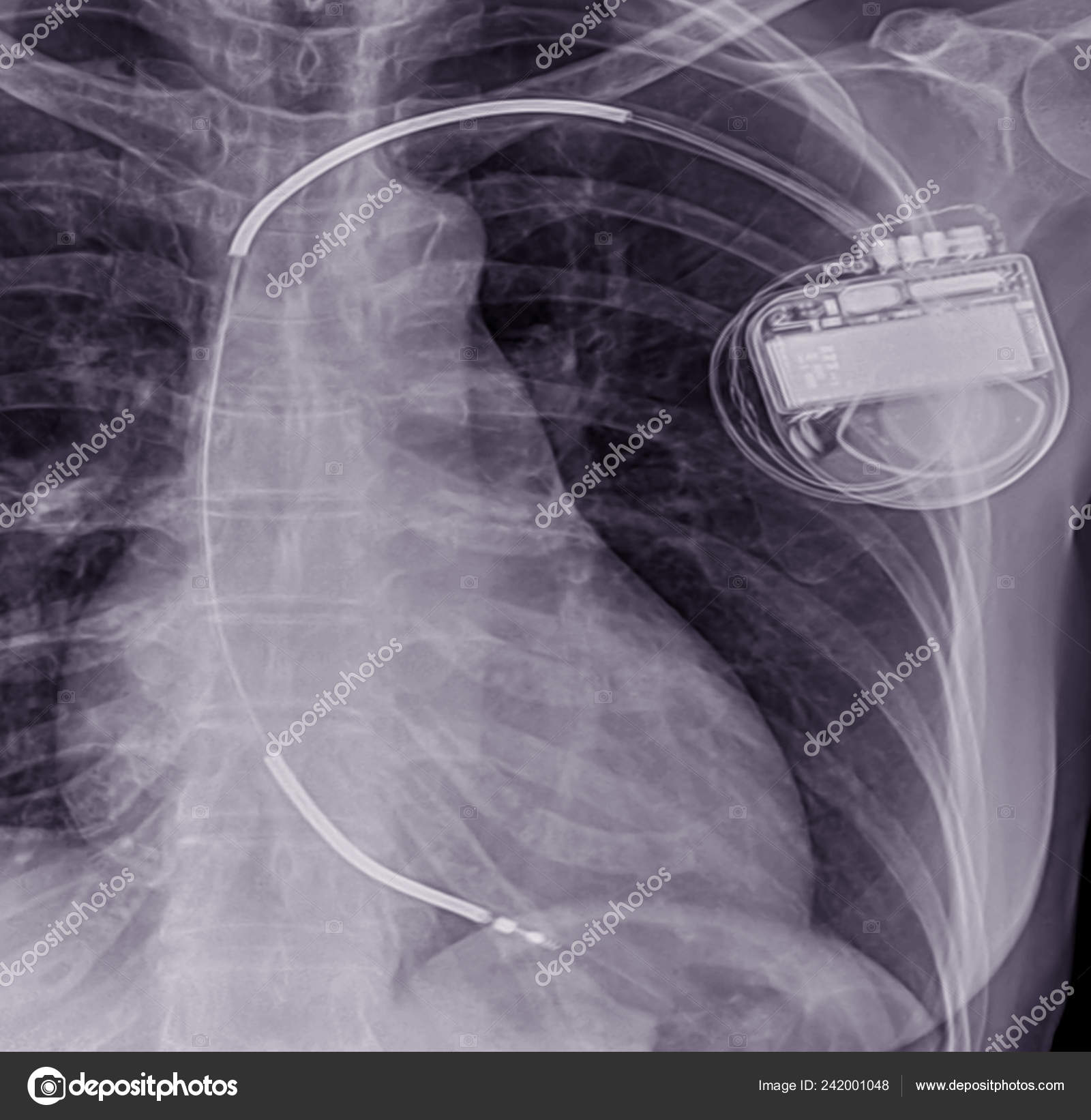 Close Chest Ray Showing Pacemaker — Stock Photo © Richmanphoto #242001048