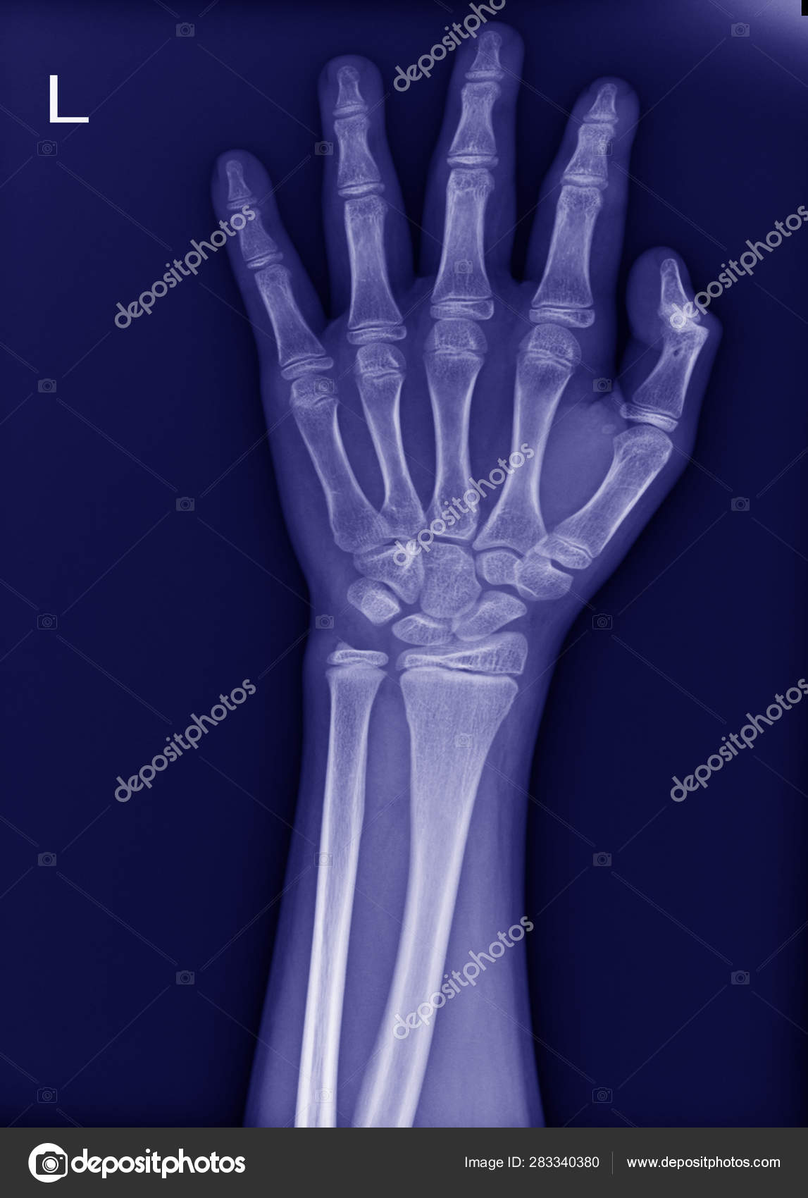 Left Wrist X Ray
