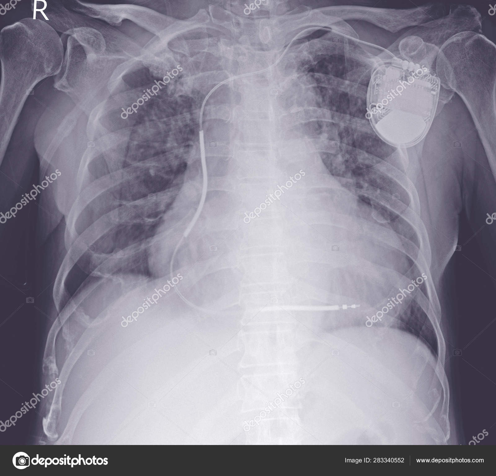 Chest x-ray evere cardiomegaly. Moderate pulmonary congestion. — Stock ...
