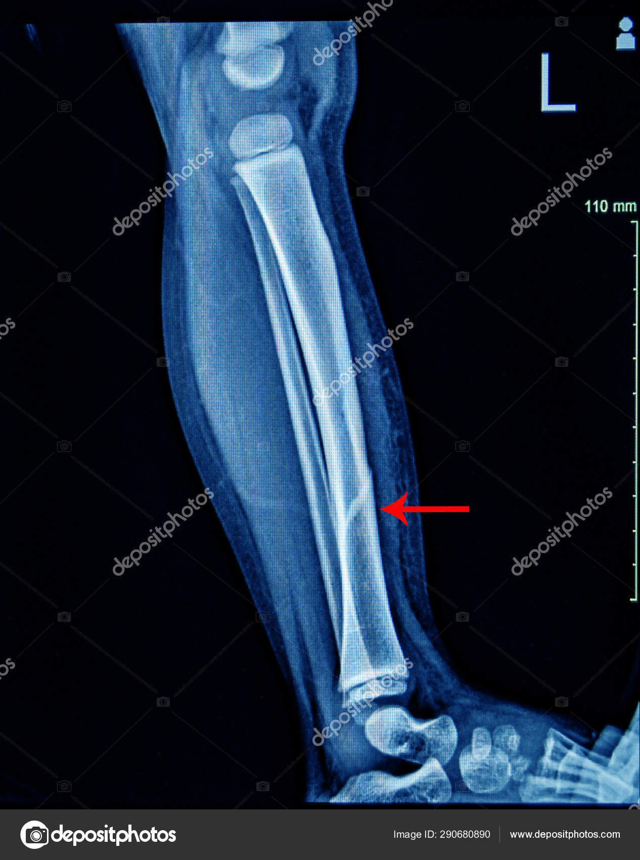 X-ray Left Leg AP Lat fracture Tibia. — Stock Photo © Richmanphoto ...