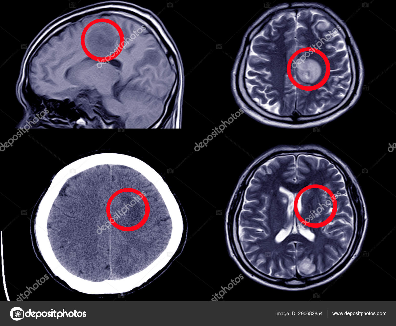 Severe Hydrocephalus Mri