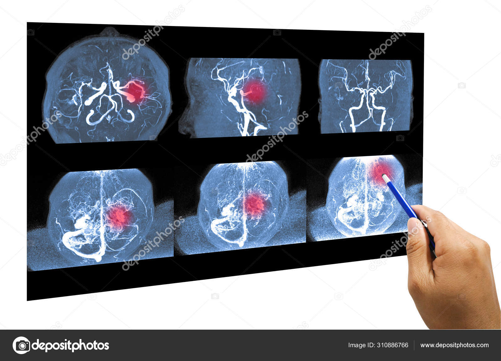 Angiografía Por Resonancia Magnética De La Arteria Cerebral — Foto De