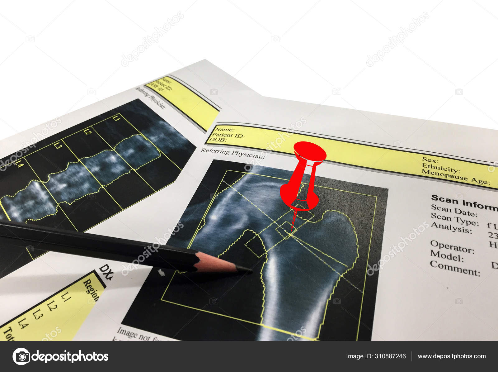Hip and Spine Bone mineral density (BMD) DEXA densitometry hip scan — Stock Photo © Richmanphoto ...