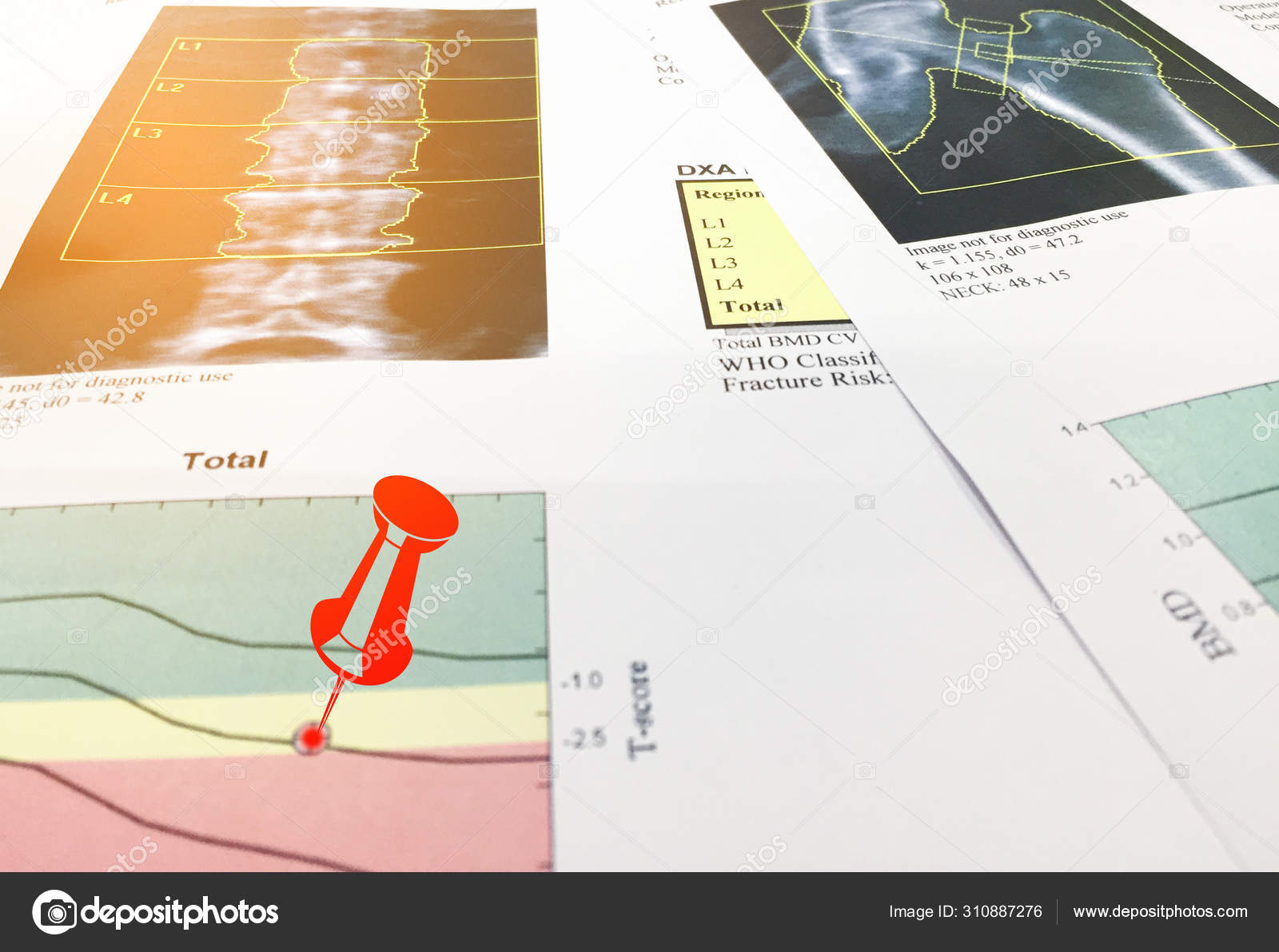 Hip and Spine Bone mineral density (BMD) DEXA densitometry hip scan. — Stock Photo ...