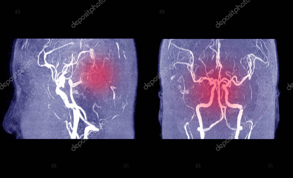 Angiograf a por resonancia magn tica de la arteria cerebral . 2024