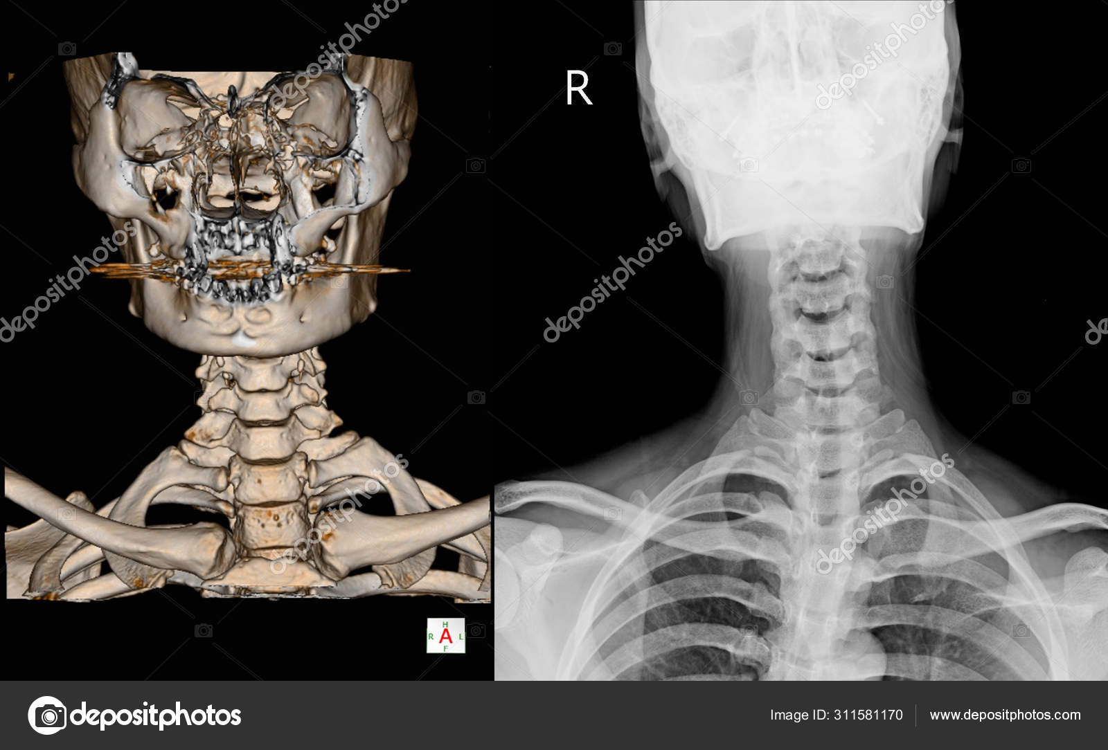 Lordose Cervical Reversa Cervical Spine Realignment And Restoring Loss