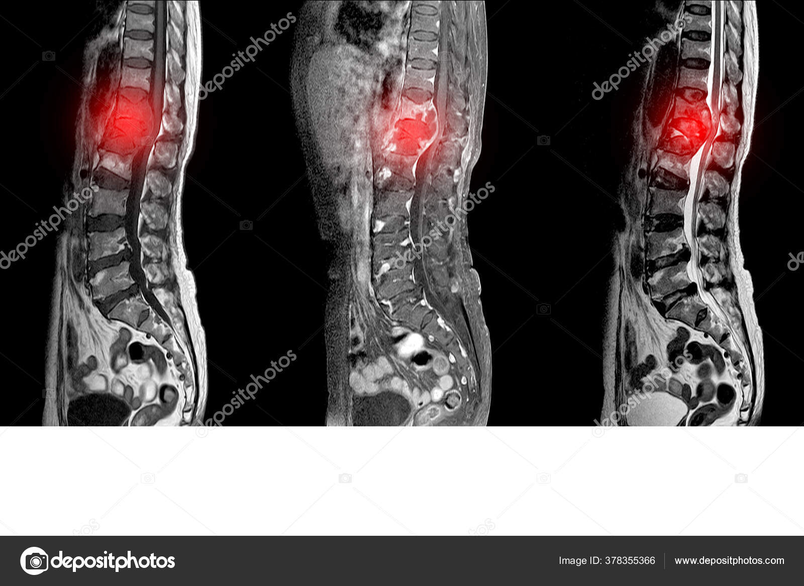 Mri Lumbosacral Spine Epidural Abscess Posterior Longitudinal Ligament ...