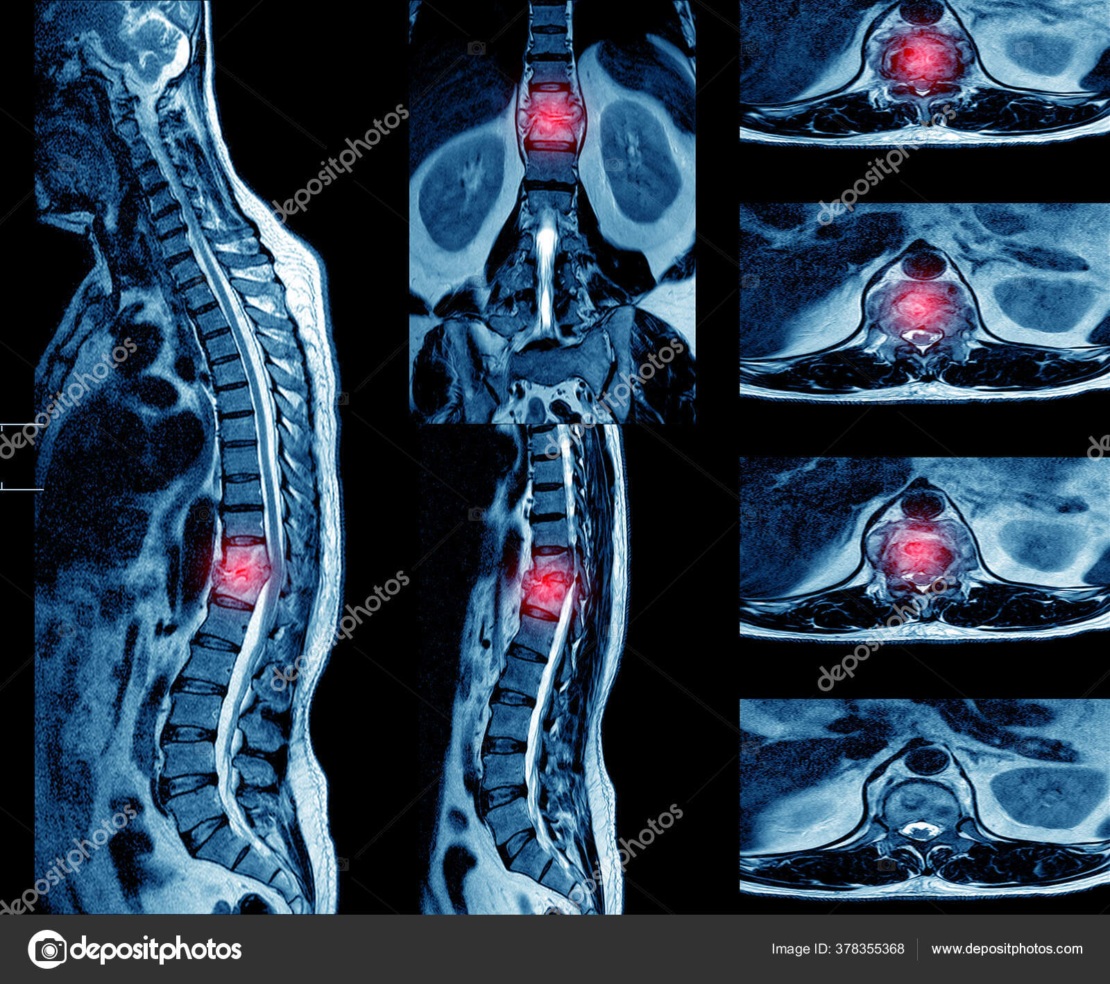 Mri Thoracic Spine Findings Suggestive Spondylodiscitis T11 Level ...